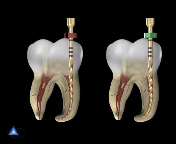 Wave One Gold For Root Canal Treatment | Riverside Dental Health ...